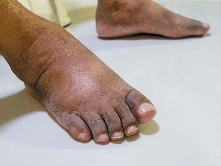 A Gp Guide To Managing Diabetes Related Foot Ulceration Australian Doctor Group